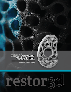 TIDAL® Anatomic Cotton Osteotomy Wedge System Brochure | restor3d