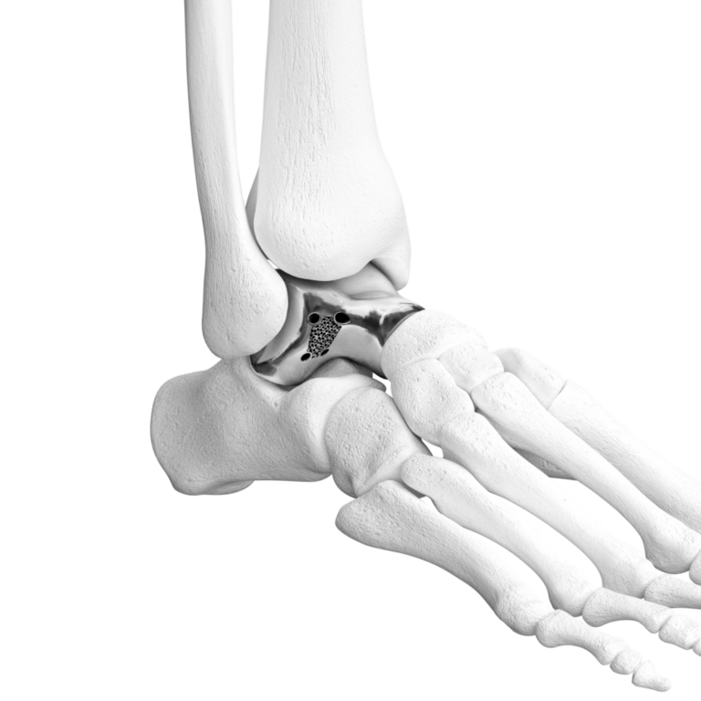 Total Talus Replacement | restor3d