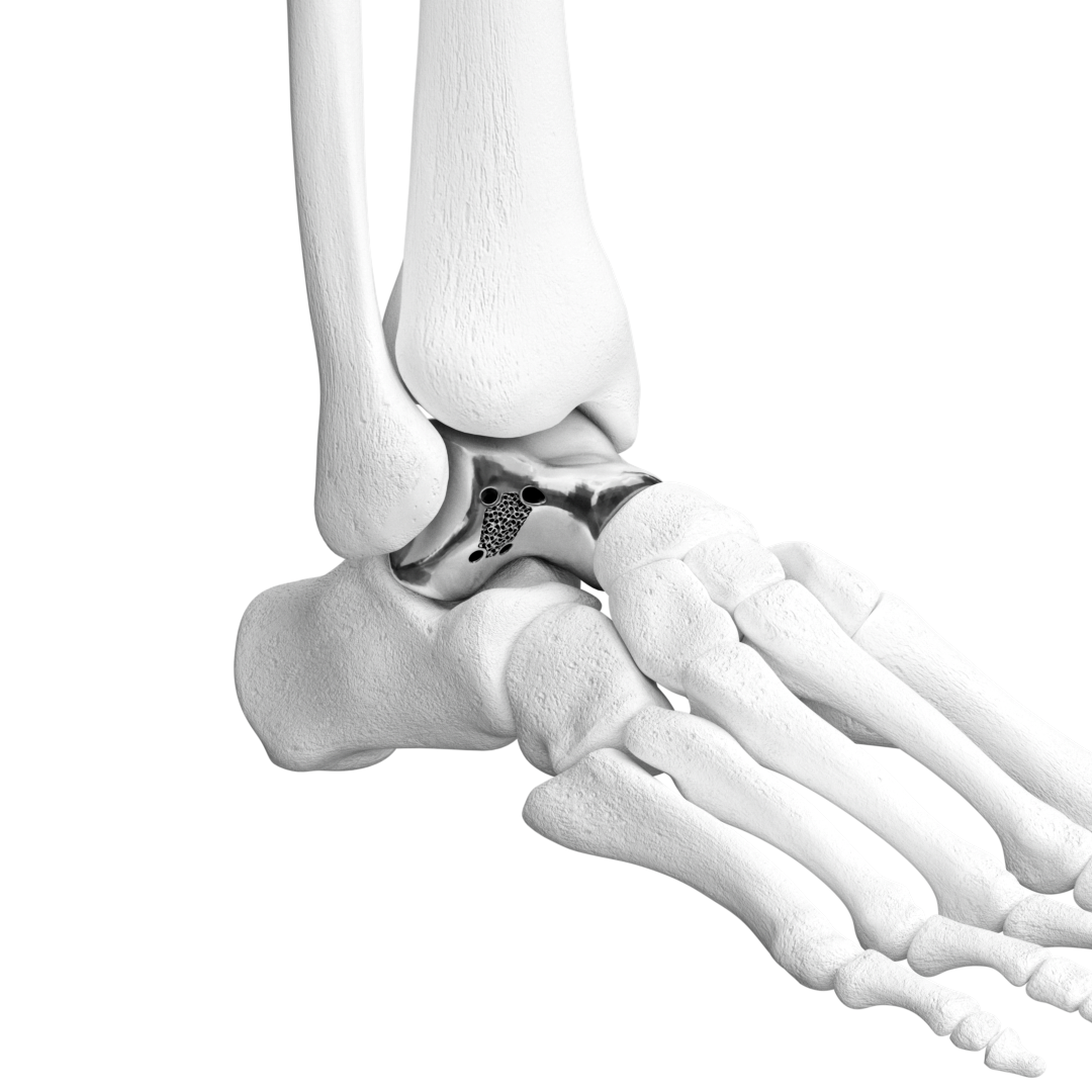 Total Talus Replacement | restor3d