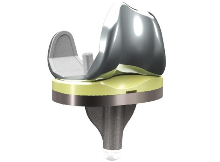 Custom Knee Implants | restor3d