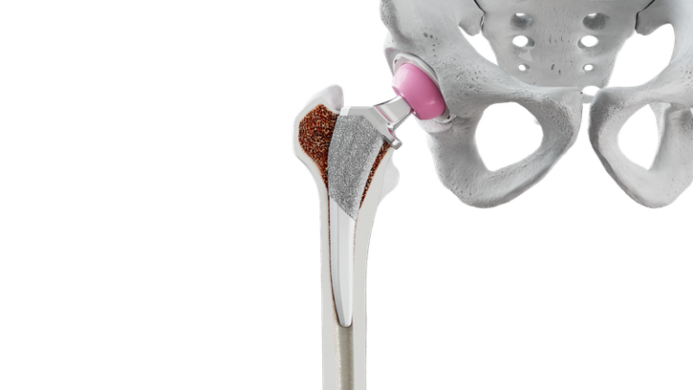 Actera™ Total Hip Stem | restor3d